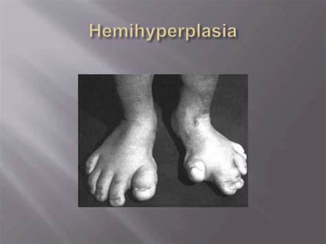 Hyperplasia Pathology By Talha Shahid Pptx