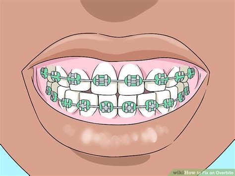 How To Fix An Overbite Steps With Pictures WikiHow