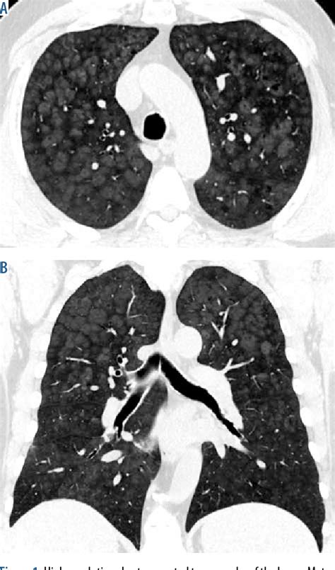 Figure 1 From Metastatic Pulmonary Calcification As A Rare Complication Of End Stage Renal