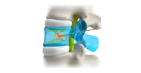 New4med Gmbh Announces First Cases Of Its Novel Basivertebral Nerve Ablation Bvna