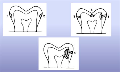 Radiographic Diagnosis Of Caries Flashcards Quizlet
