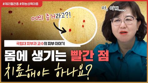 몸에 생긴 🔴빨간 점🔴이 혈관종이라고요😨｜체리혈관종 화농성 육아종🤔치료해야 하는 건가요 언니네피부과 Youtube