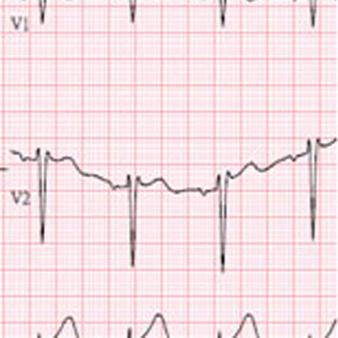 Typical Electrocardiogram Patterns And Classification Of Brugada Download Scientific Diagram