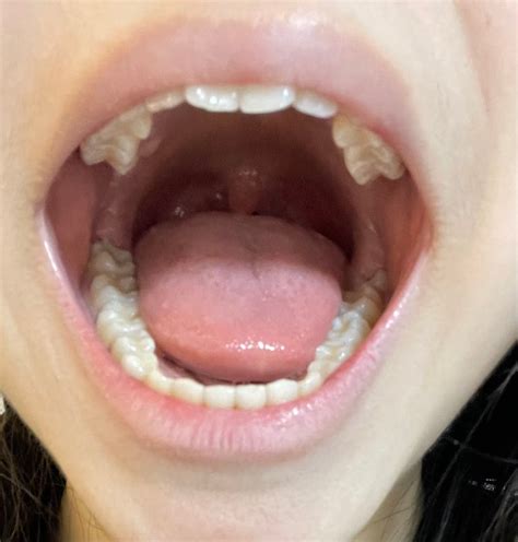 입 안 볼쪽이 부었어요ㅠㅠ 치과에 가야하나요 지식in