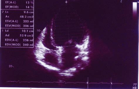 Transthoracic Echocardiography Demonstrated Global Hypokinesia Of The Download Scientific