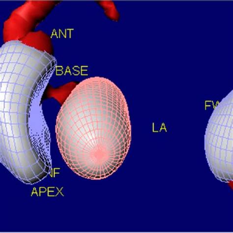 Example Of Spect Radionuclide Angiography Regional And Global