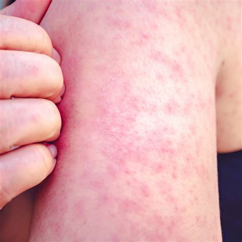 Measles Case Confirmed In Ni Highland Radio Latest Donegal News And Sport