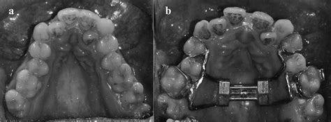 Bonded Sarpe Appliance A Before Operation And B After Activation