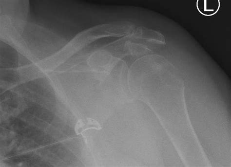 Proximal Humerus Fractures Trauma Orthobullets