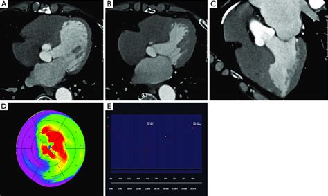 Cardiac Computed Tomography Scan Of A Patient With Hfpef A
