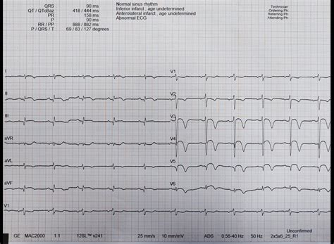Diffuse Lad And Lv Thrombus As Possible Manifestation Of Protein S Deficiency In A Young Patient