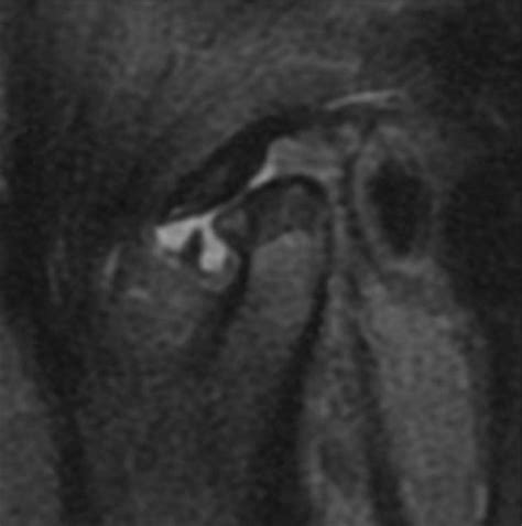 Joint Effusion Sagittal T2 Weighted Image With Fat Saturation Showing Download Scientific