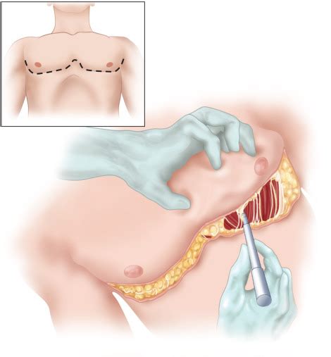 Surgical Incisions Thoracic Key