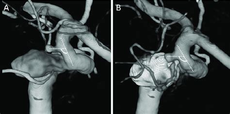 Three Dimensional Dsa 3d Dsa Of The Left Ica A Preoperative Image