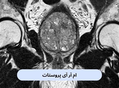 ام آر آی پروستات پزشکی لند