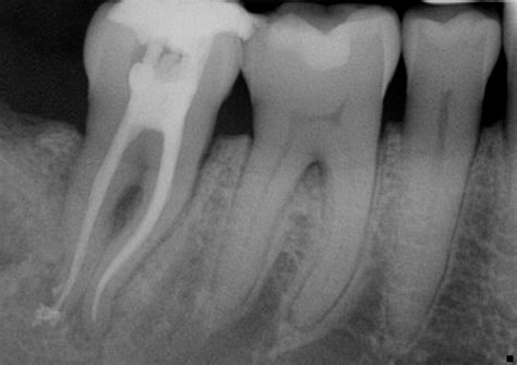 Vertical Root Fractures The Diagnostic Dilemma And Hidden Menace