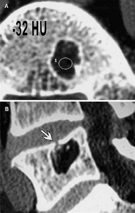 Case 1 Axial And Sagittal Mpr Of A Giant Fatty 32 Hu Schmorls Node