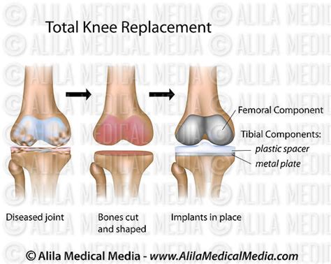 Alila Medical Media Total Knee Replacement Surgery Diagram Medical