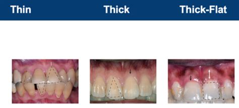 Perio Chp 7 Mucogingival Deformities And Conditions Flashcards Quizlet