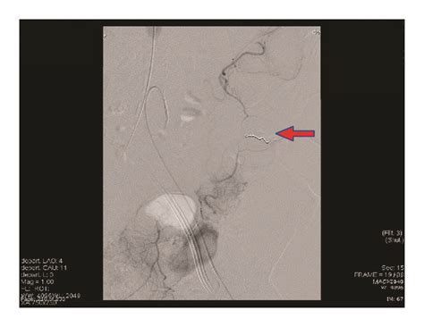 Super Selective Embolization A Before And B After Coil Deployment Download Scientific