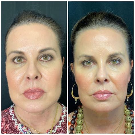 Patient 8693765 Morpheus8 Before And After Photos Austin Face And Body