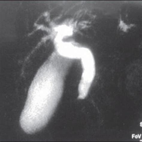 Mrcp Revealed Biliary Tract Dilation Download Scientific Diagram