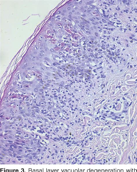 Figure 3 From Toxic Epidermal Necrolysis Like Subacute Cutaneous Lupus