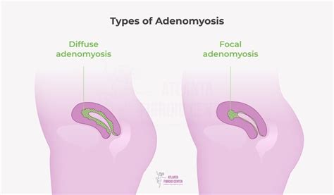 What Is Really Known About The Adenomyosis Stages