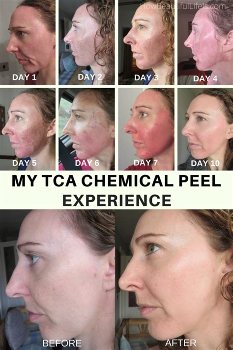 My Tca Chemical Peel Experience How Beautiful Life Is