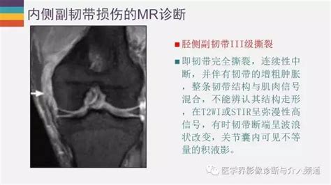 【ppt】膝关节内侧副韧带解剖及损失mr诊断 影像ppt