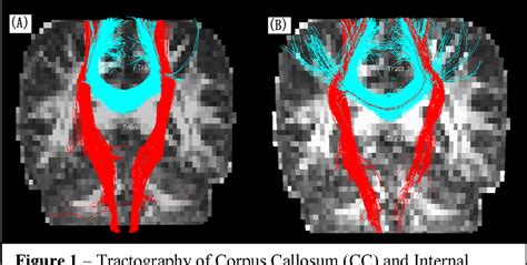 Figure 1 From Human Brain Tractography A Dti Vs Dki Comparison