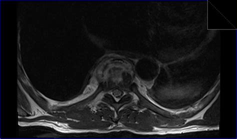 Discitis Mri Radiology Article On How To Report Spondylodiscitis Discitis Mri Radiology Article On How To Report Spondylodiscitis