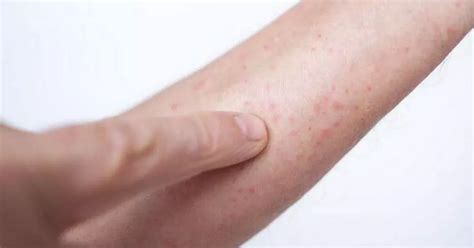 Scabies Outbreak Uk Rash Pictures Symptoms And How To Get Rid Leeds Live