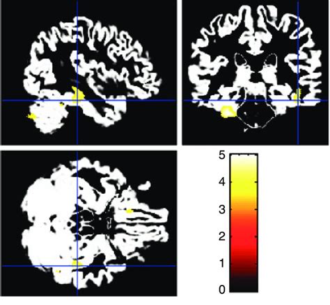 Whole Brain Voxel Based Morphometry Vbm Showing Areas With Download Scientific Diagram