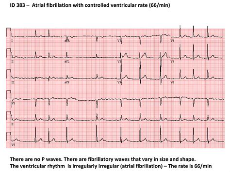 Stepwise Interpretation Of Ecg 4 Id383 Ppt