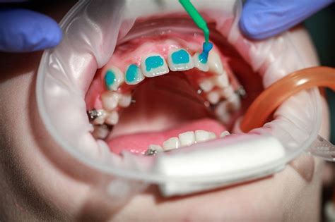 Removing Invisalign Buttons The Right Way Artofit