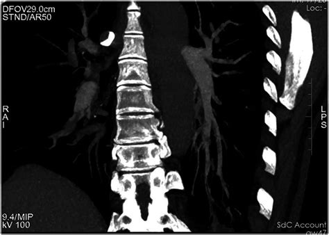 Syncope With Qt‐interval Prolongation And T‐wave Inversion In Anterior