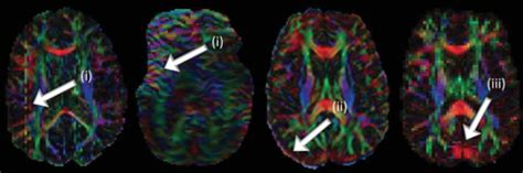 Dti Quality Control Part 4 Further Reading Diffusion Imaging