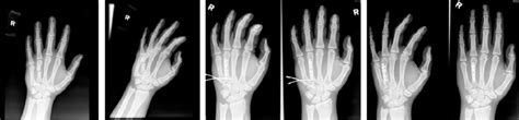 Displaced Fracture Shaft Of Right 4 Th Metacarpal And Dorsal