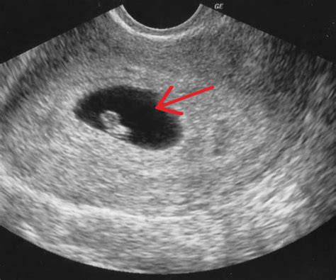 Qué Es Y Cuánto Mide El Saco Gestacional Por Semanas ¡con Infografías