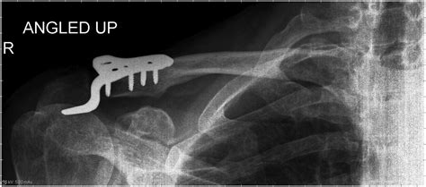 Concomitant Coracoid Base Fracture And Acromioclavicular Joint Disruption A Series Of Patients