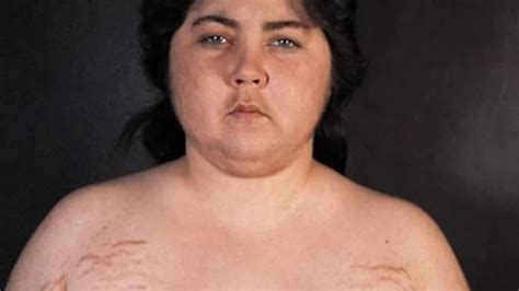 Qué Es El Síndrome De Cushing La Enfermedad Que Te Pone La “cara De Luna Llena” Infobae