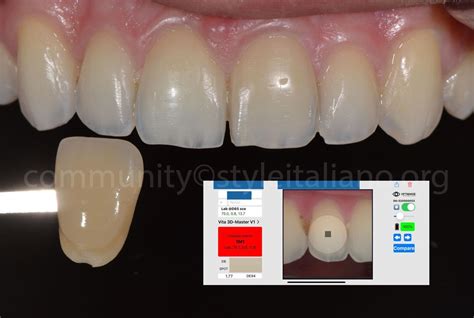 Track Your Patients Home Bleaching Journey The Styleitaliano Way A