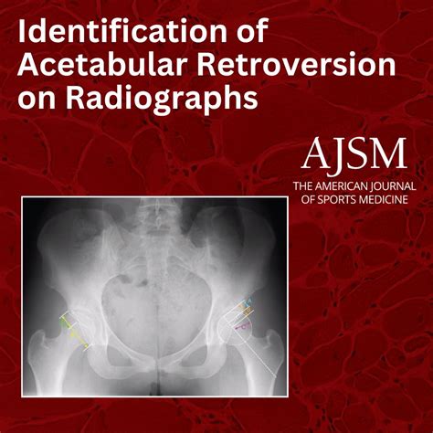 Identification Of Acetabular Retroversion On Radiographs… Aossm Journals