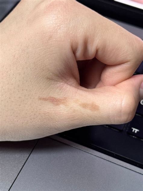 피부에 검게 착색된 부분이 생겼습니다 지식in