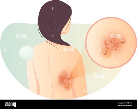 One Side Rashes On The Back Herpes Zoster Shingles Stock Illustration As Eps 10 File Stock