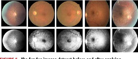 figure 1 from a hybrid convolutional neural network model for automatic diabetic retinopathy