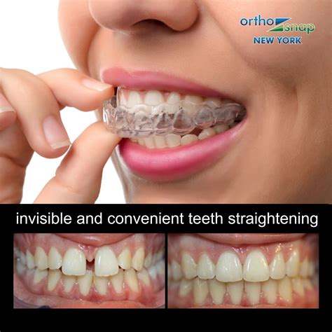 Pin By Hanan Hirzallah On Dentist In 2023 Fix Teeth Teeth