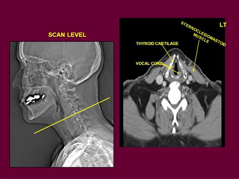 Thyroid Cartilage X Ray