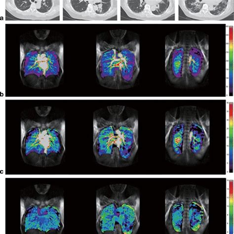 Female 73 Year Old With Scleroderma Thin Section Ct Demonstrates